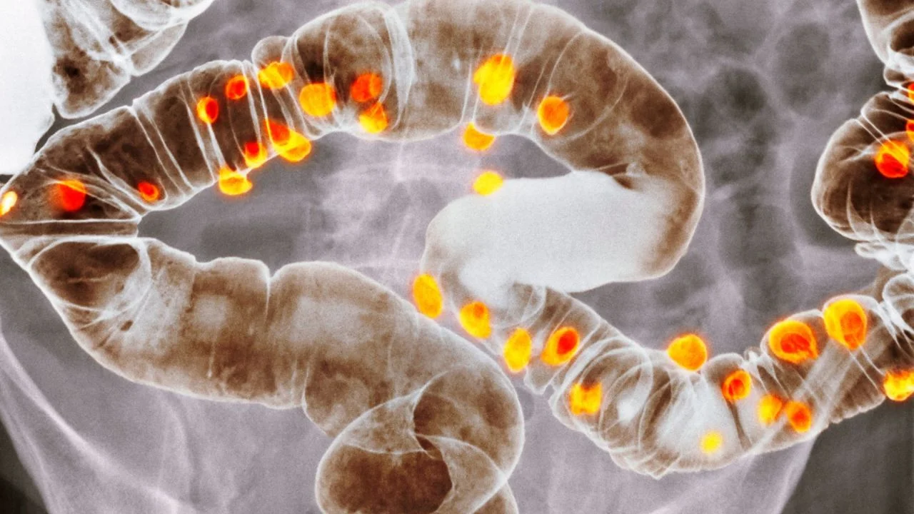 Diverticolosi e diverticolite: cosa fare con i diverticoli