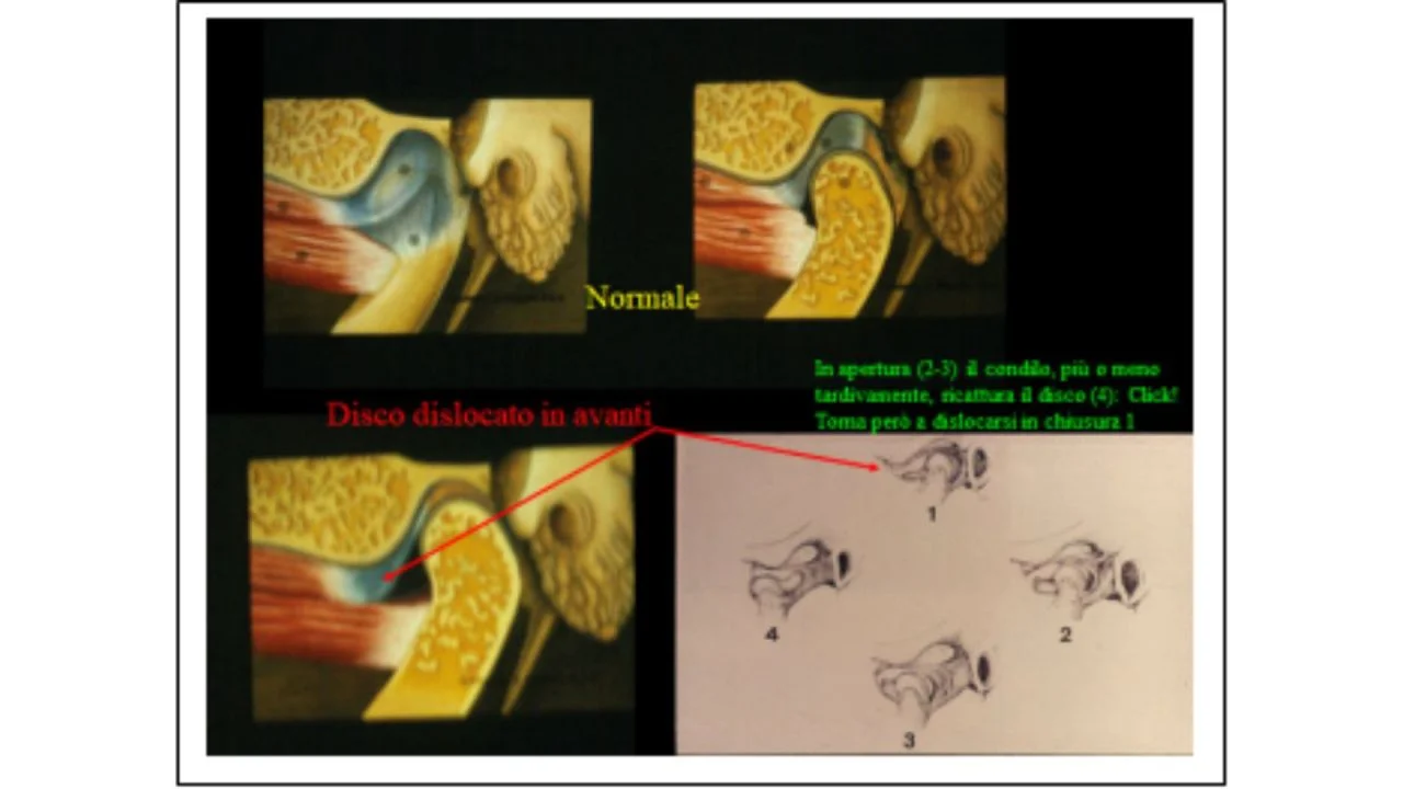 Articolazione temporo mandibolare: click e scrosci da incoordinazione ...
