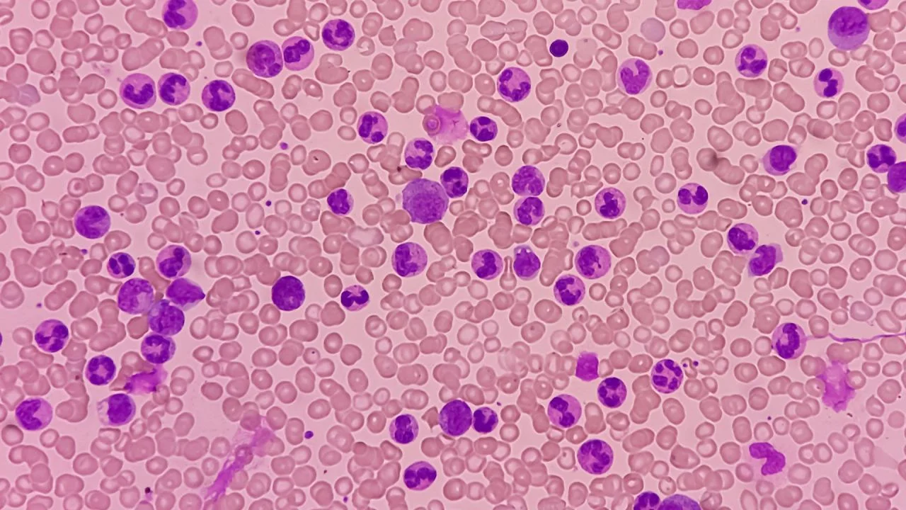 Leucemia mieloide acuta: aspettative e prognosi