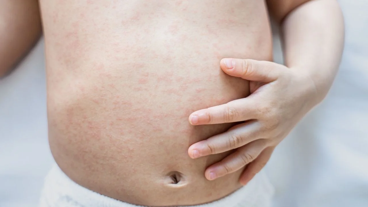 Rosolia: sintomi, vaccino e rischi in gravidanza